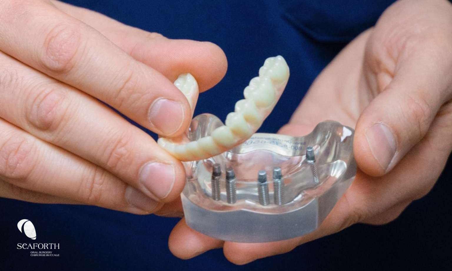 Implant-Supported Dentures: A Complete Guide