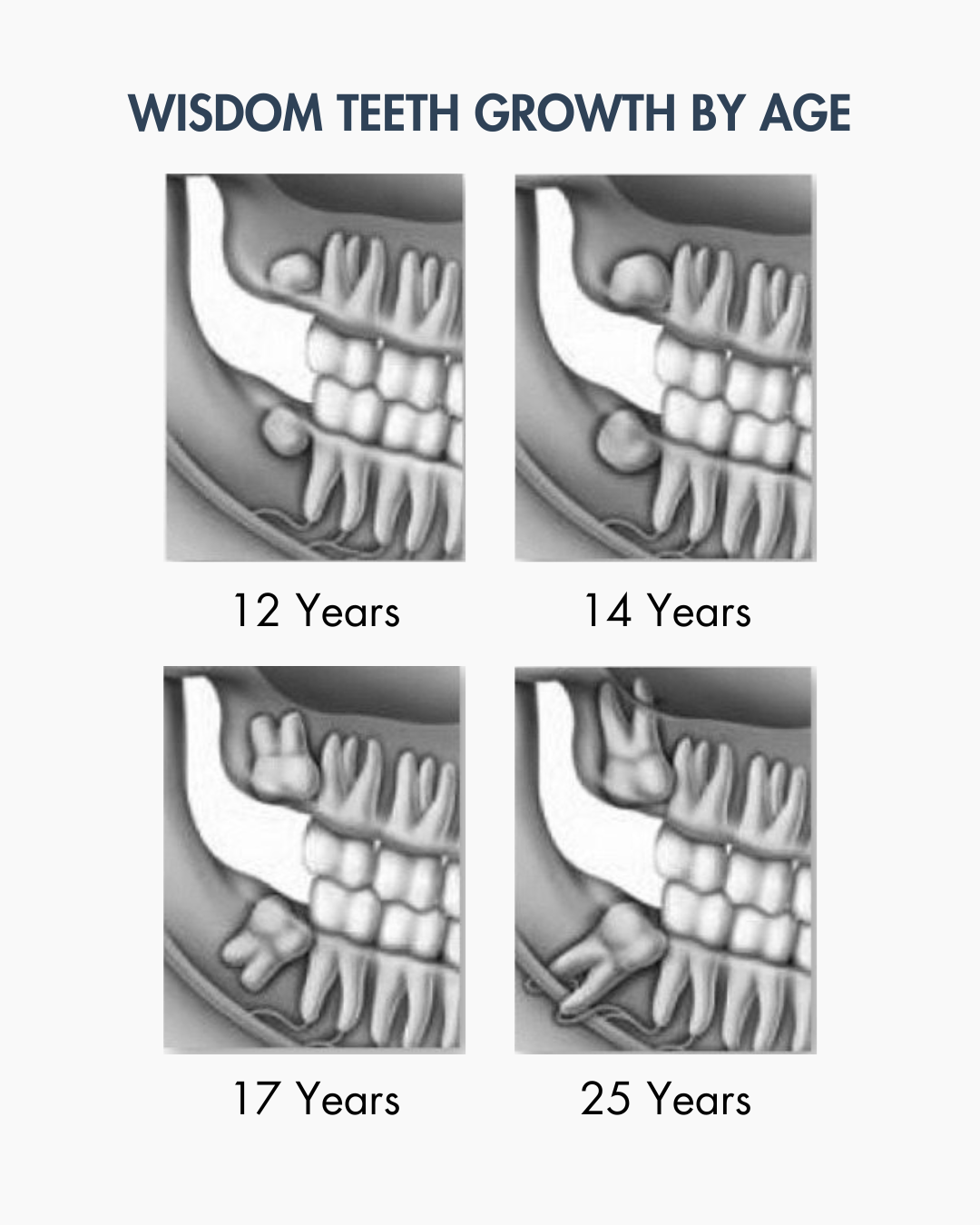 Everything to know about wisdom teeth removal in Montreal