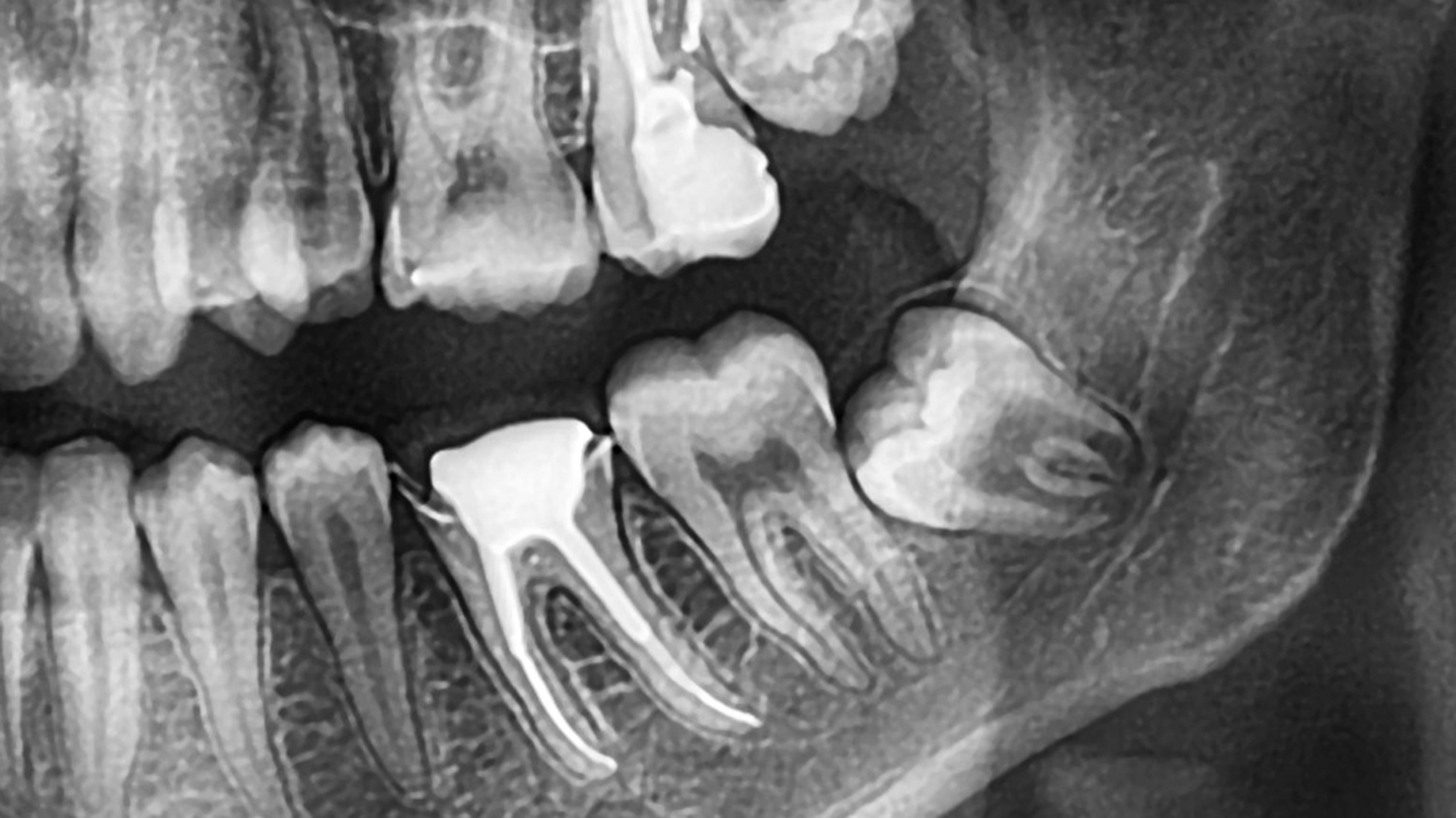 Everything to know about wisdom teeth removal in Montreal