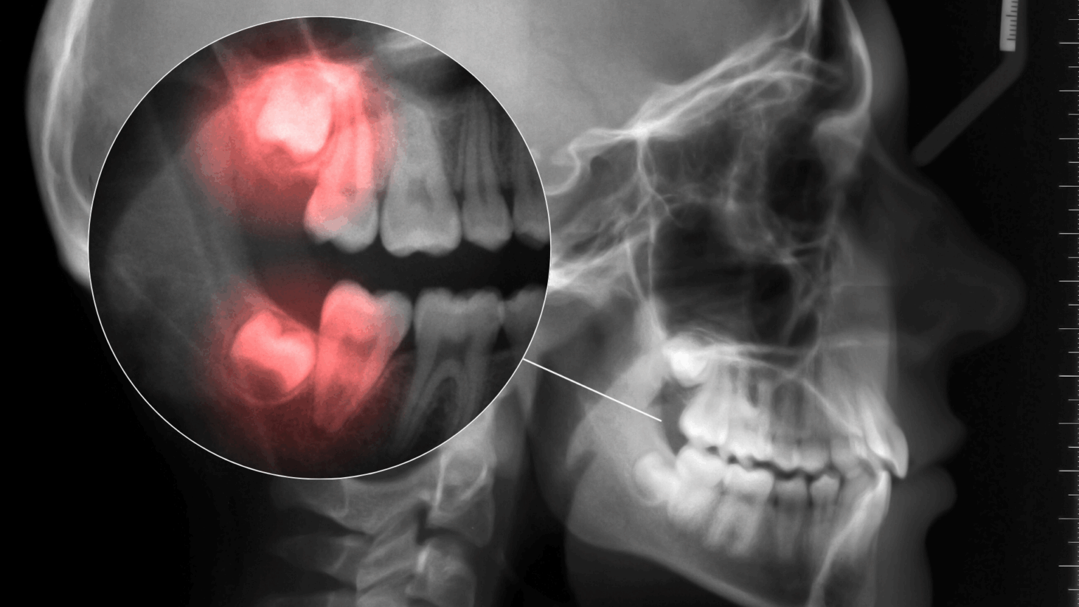 Wisdom Tooth Pain: Normal or a Cause for Concern?