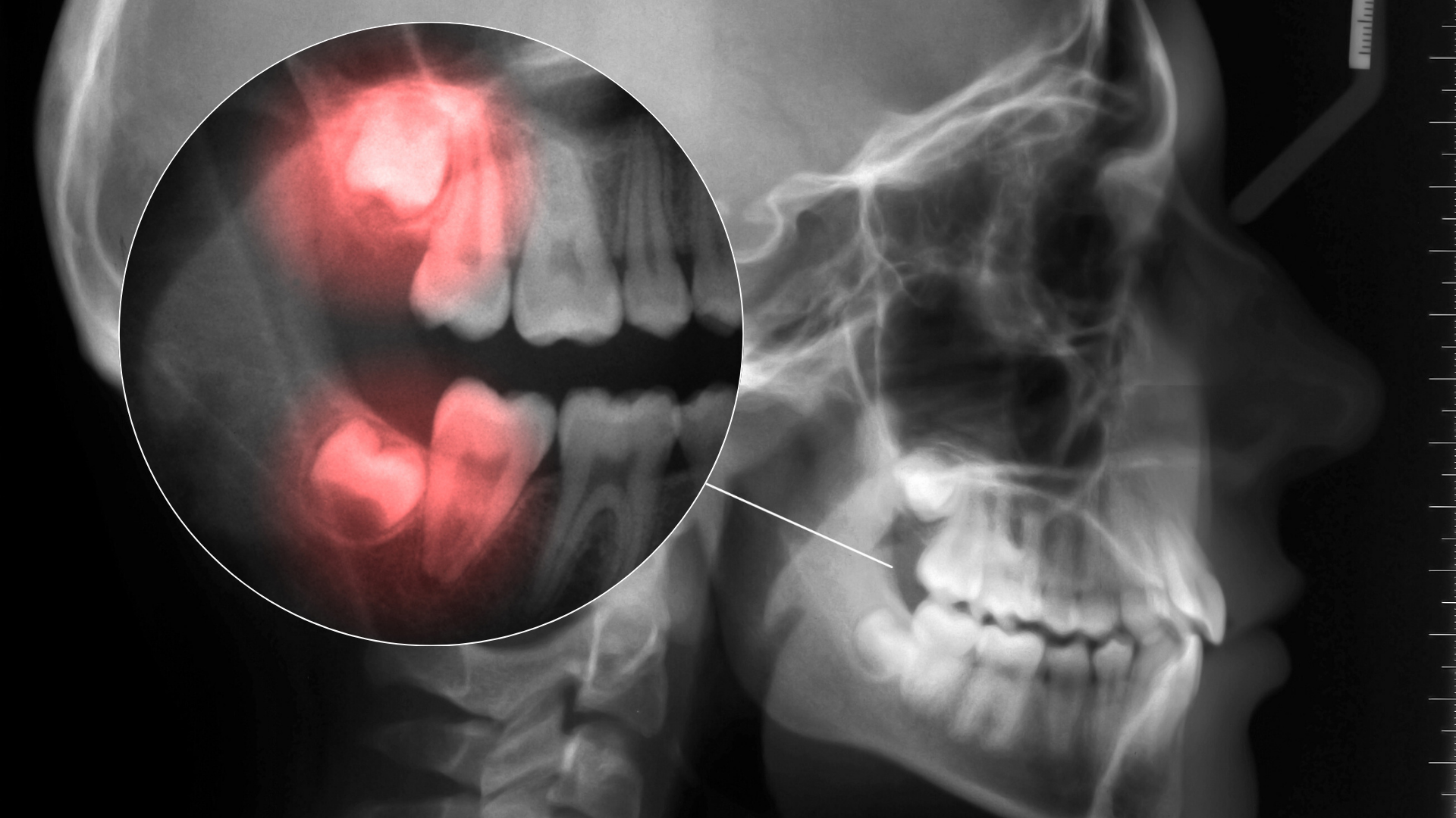 Wisdom Tooth Pain: Normal or a Cause for Concern?