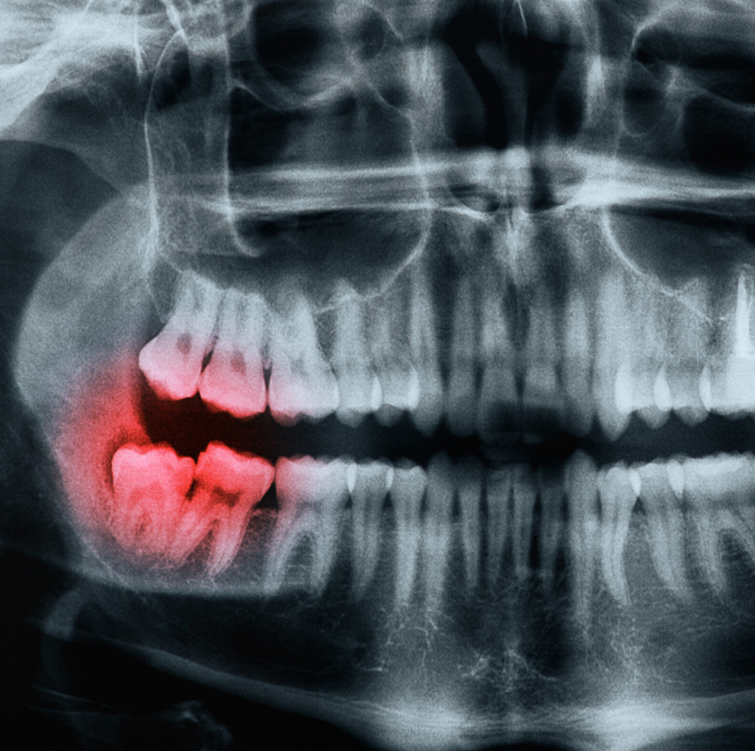 Wisdom Tooth or Sore Throat? How to Tell