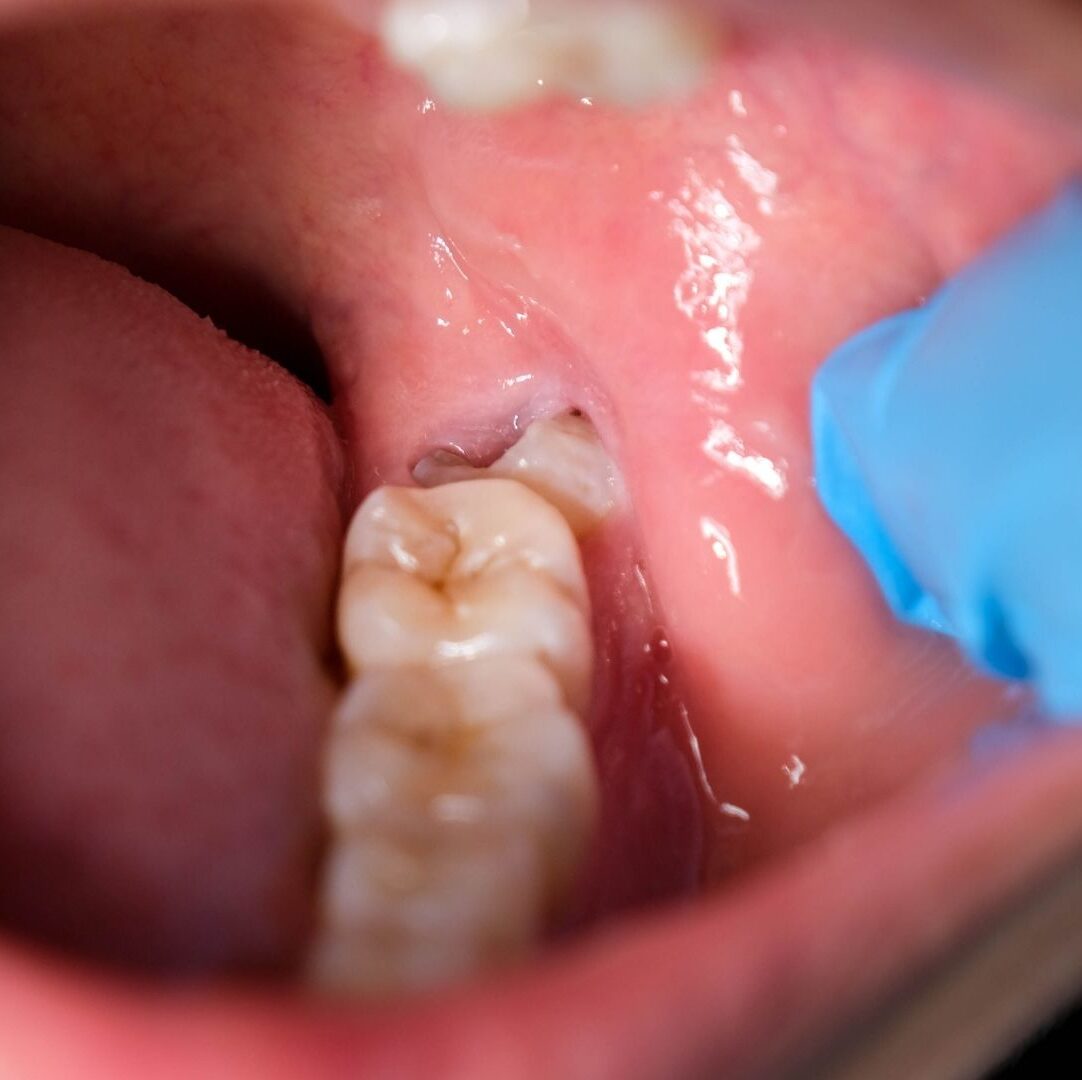 Wisdom Tooth or Sore Throat? How to Tell