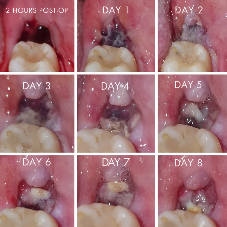 Dry Socket After Tooth Extraction: Symptoms & Treatment
