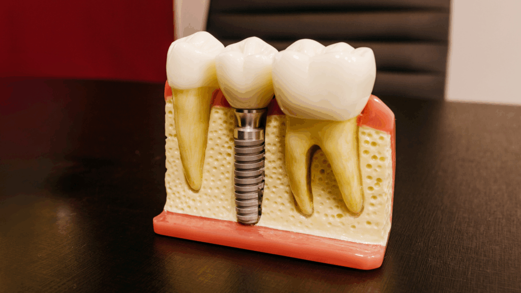 Single Tooth Dental Implant in Montreal | Seaforth